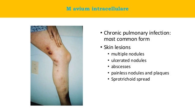Atypical mycobacterial infections in dermatology