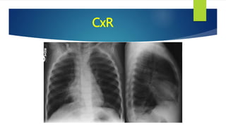 Atypical pneumonia | PPTX
