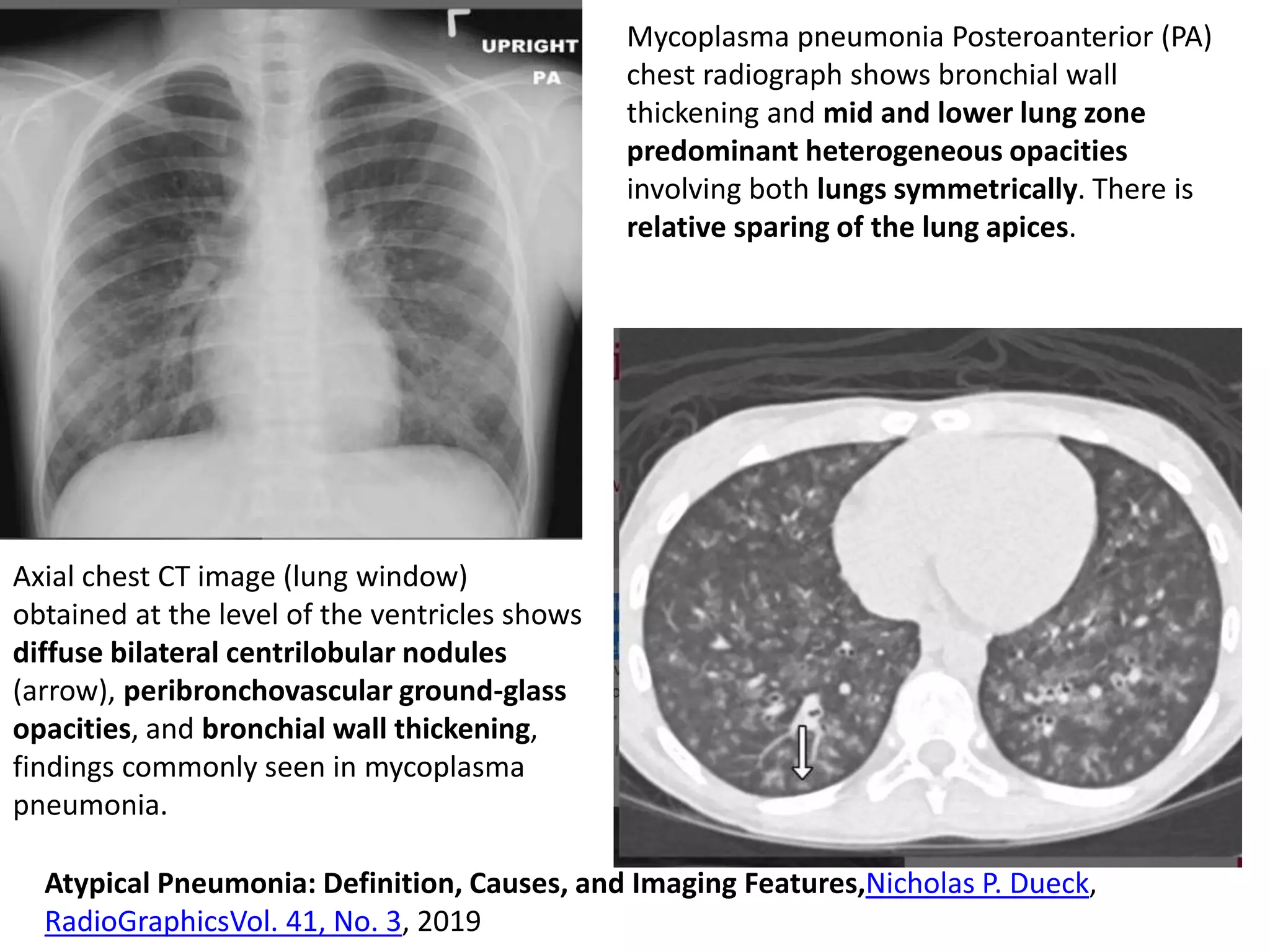 atypical pneumonia.pptx