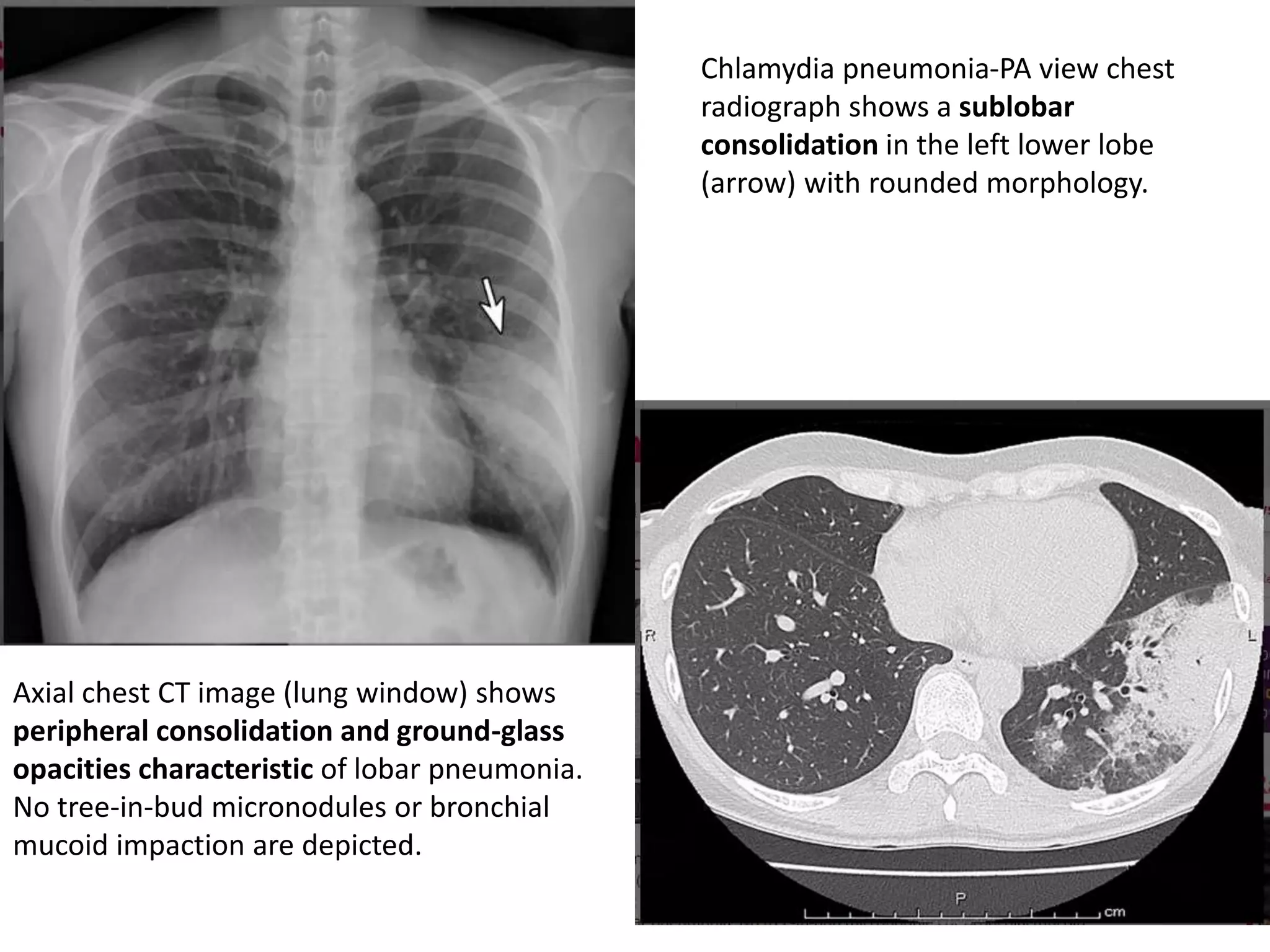 atypical pneumonia.pptx