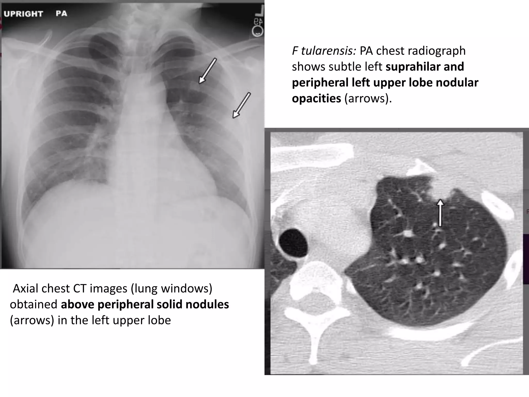 atypical pneumonia.pptx