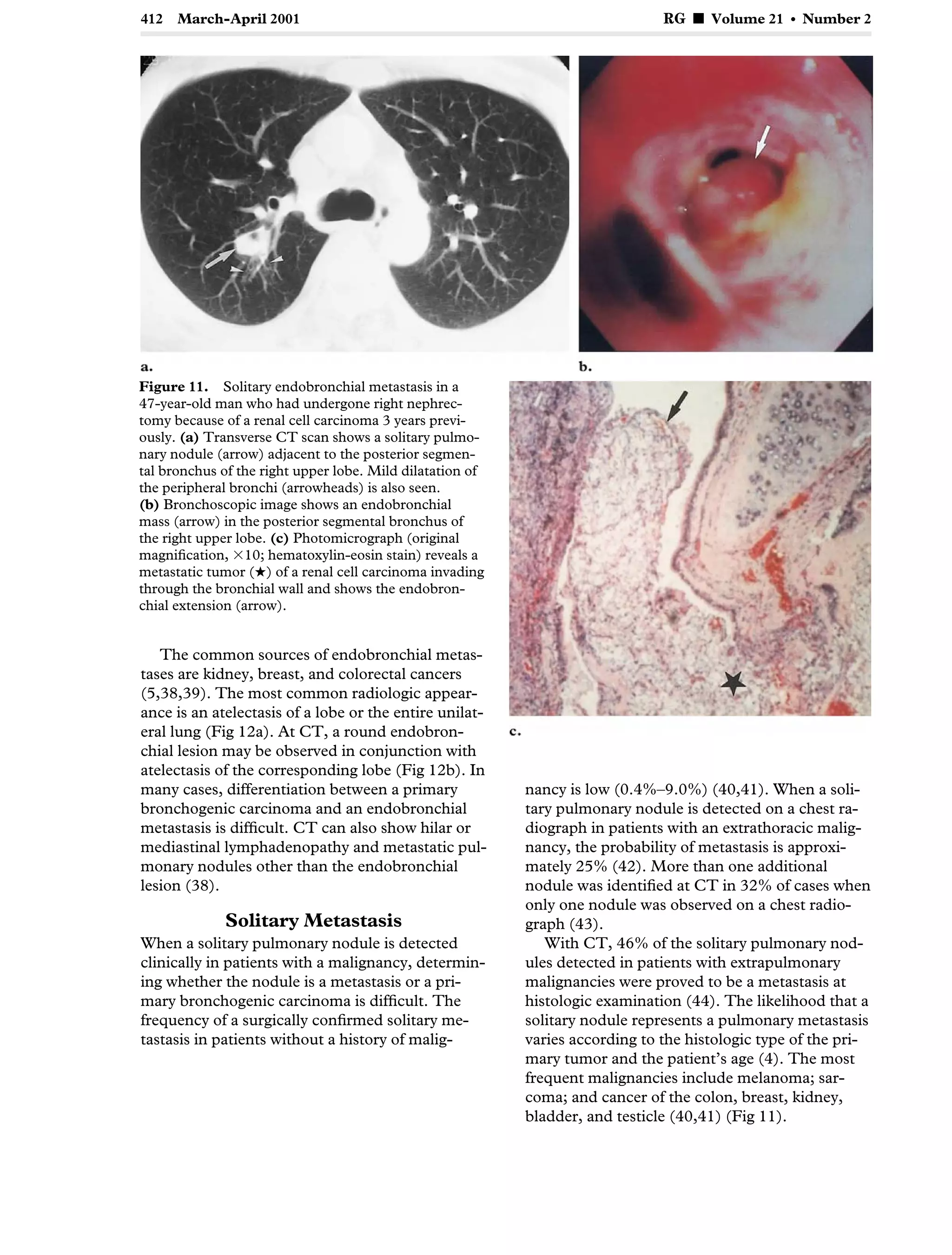 Atypical pulmonary metastases | PDF