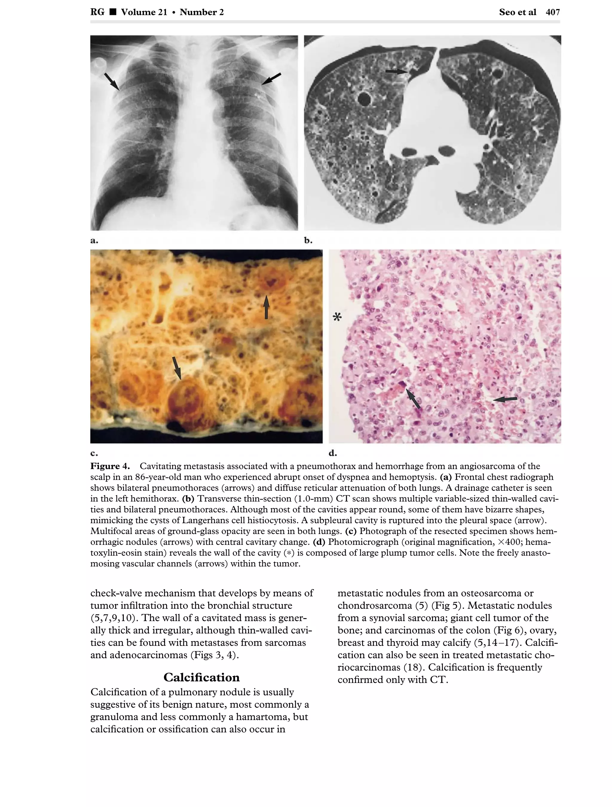 Atypical pulmonary metastases | PDF