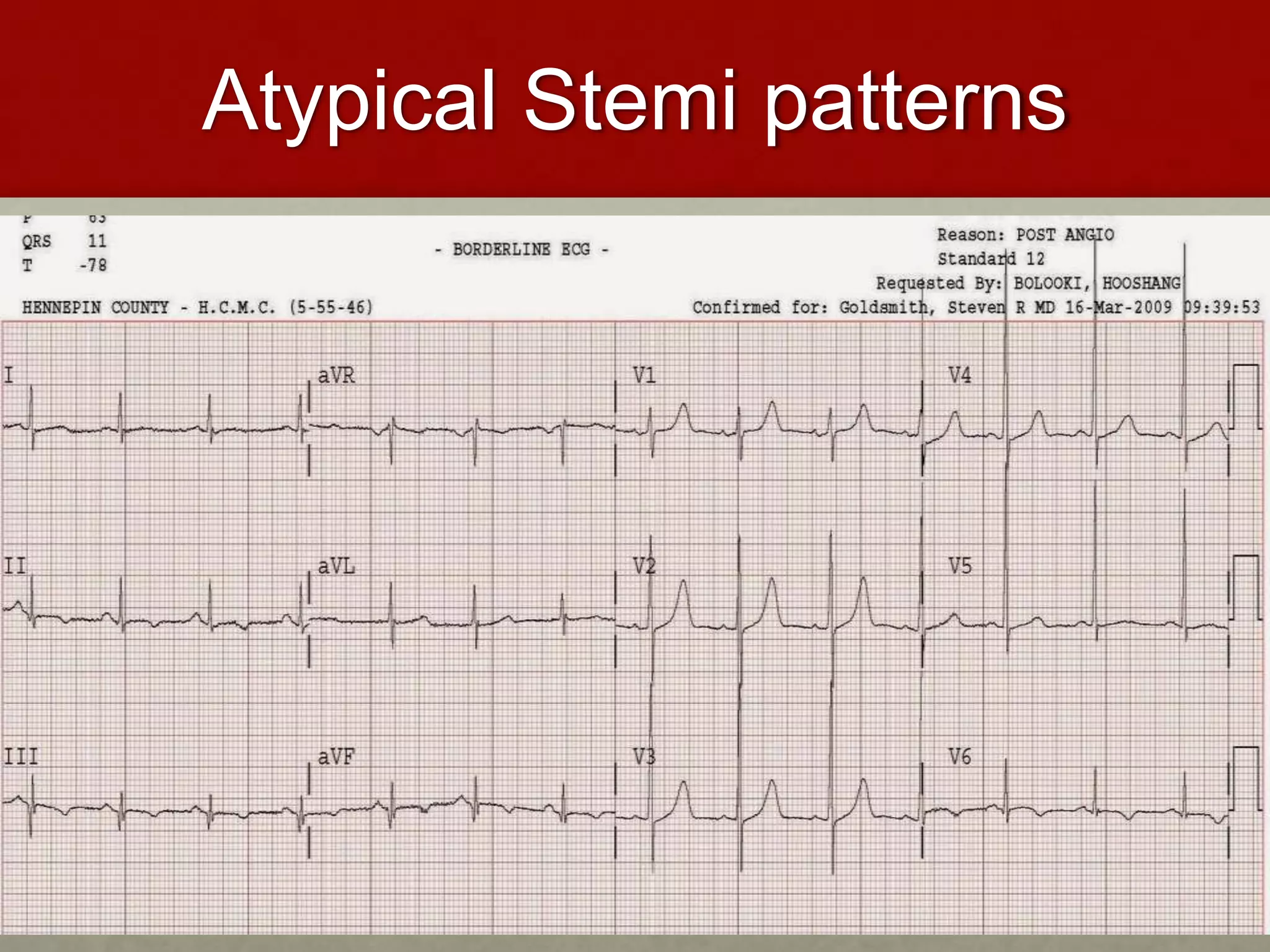 Atypical stemi patterns and stemi equivalents | PPTX | Heart and ...
