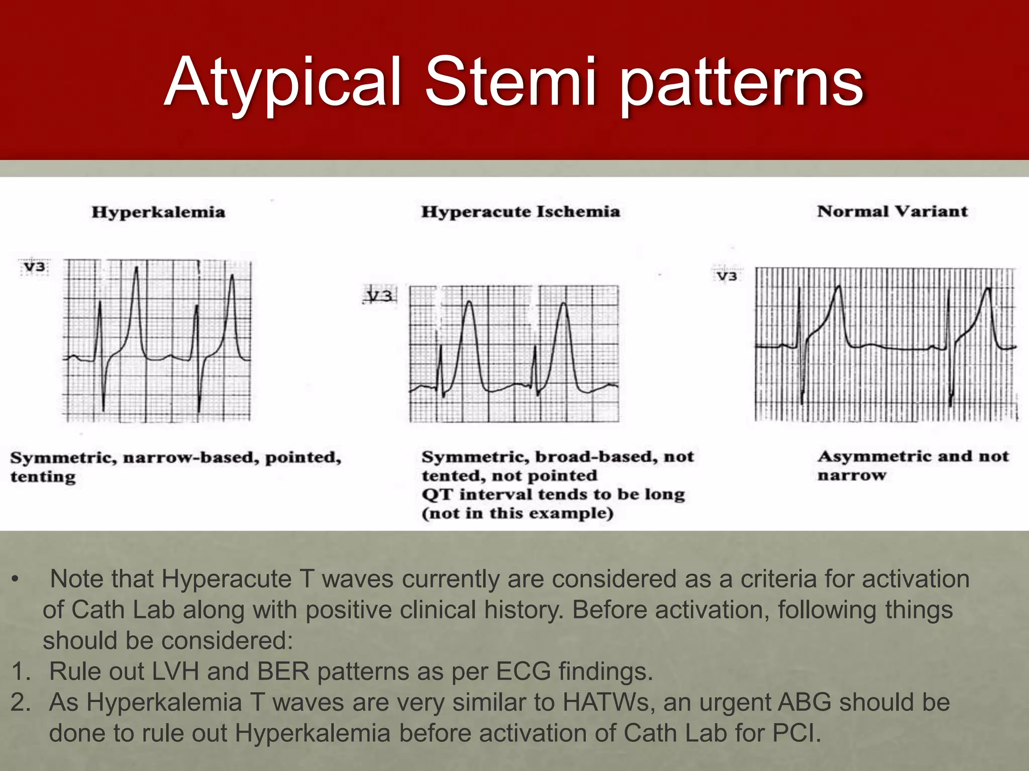 Atypical stemi patterns and stemi equivalents | PPTX | Heart and ...