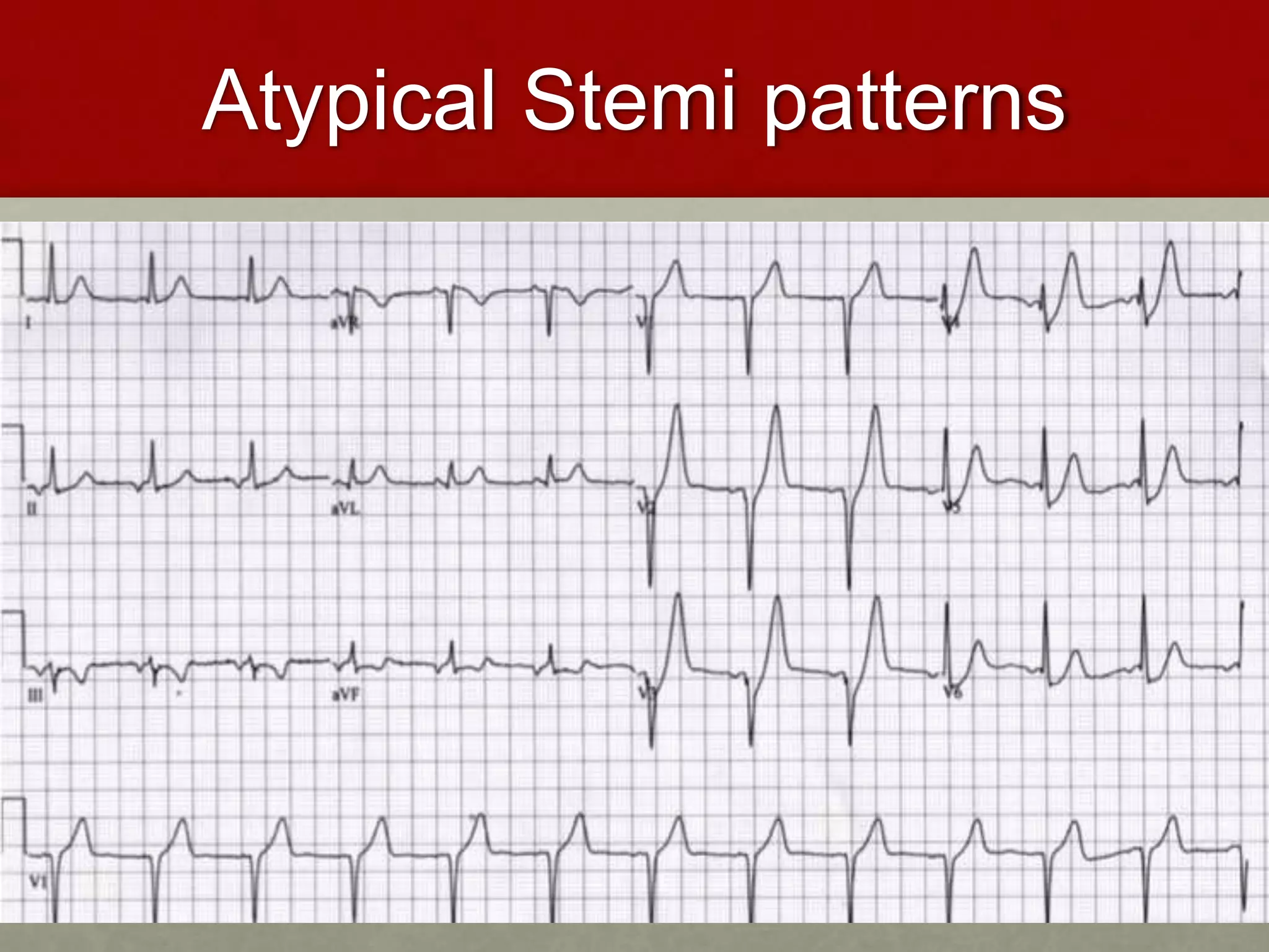 Atypical stemi patterns and stemi equivalents | PPTX