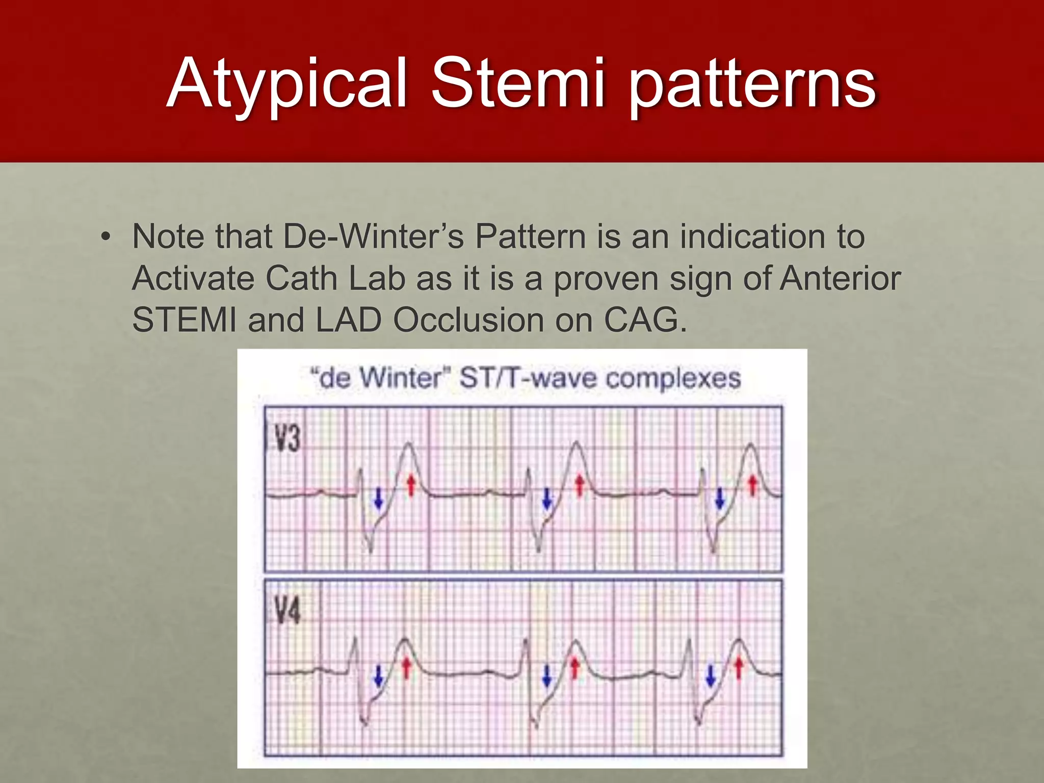 Atypical stemi patterns and stemi equivalents | PPTX | Heart and ...