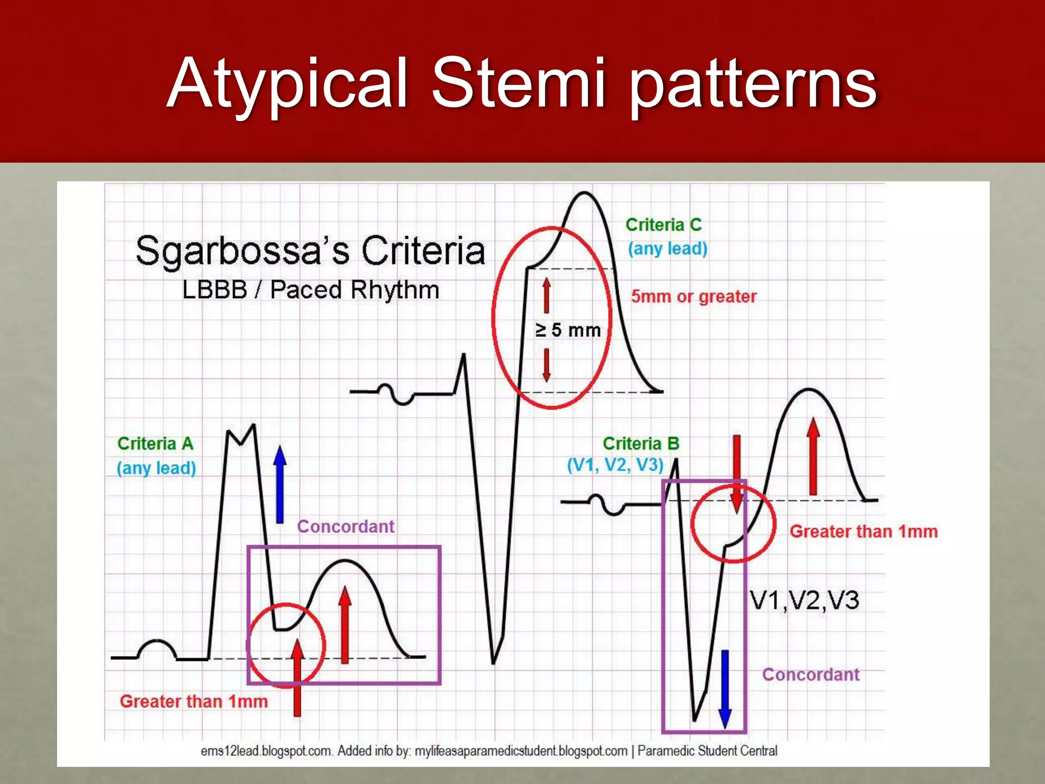 Atypical stemi patterns and stemi equivalents | PPTX | Heart and ...