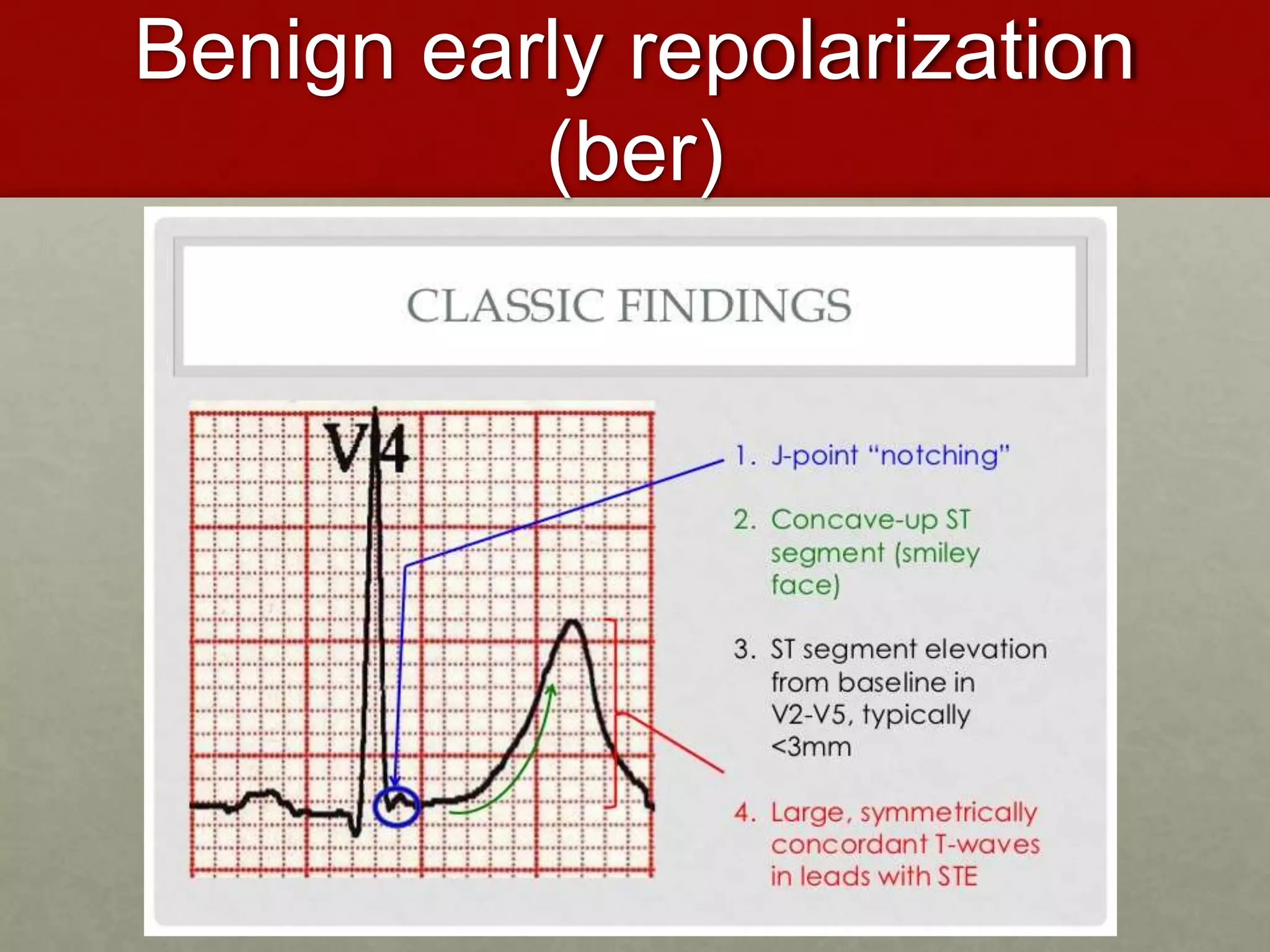 Atypical stemi patterns and stemi equivalents | PPTX