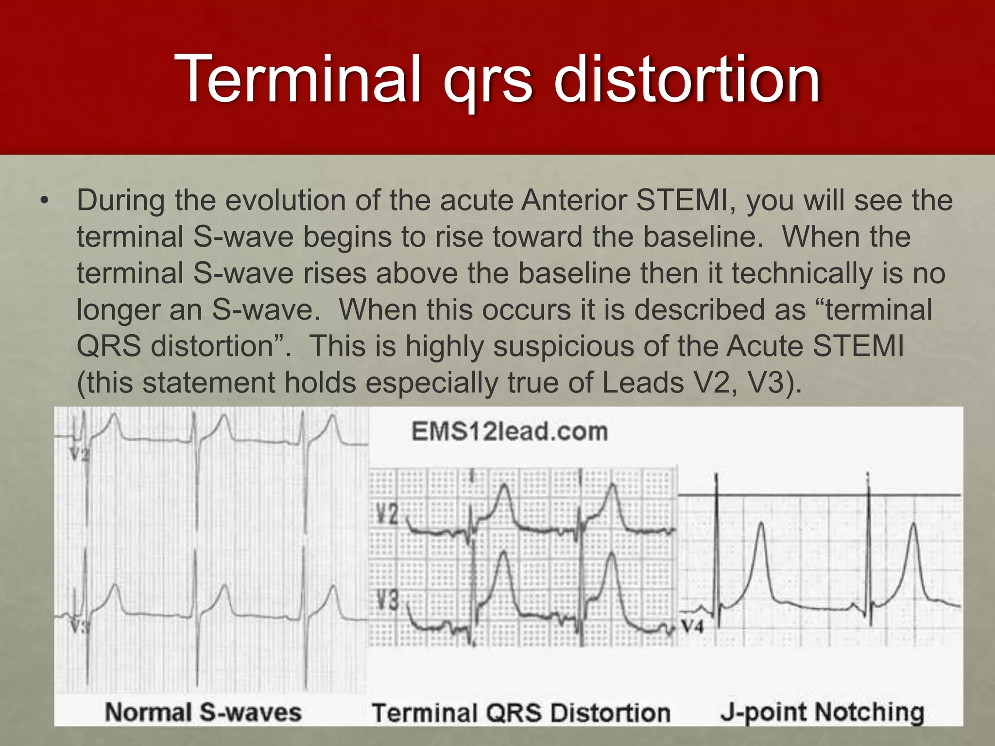 Atypical stemi patterns and stemi equivalents | PPTX | Heart and ...