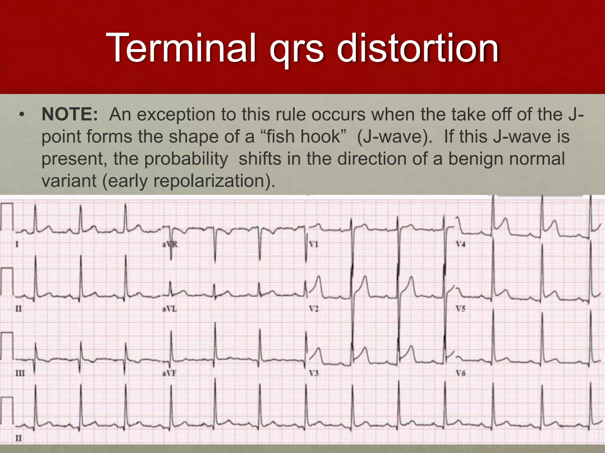 Atypical stemi patterns and stemi equivalents | PPTX | Heart and ...