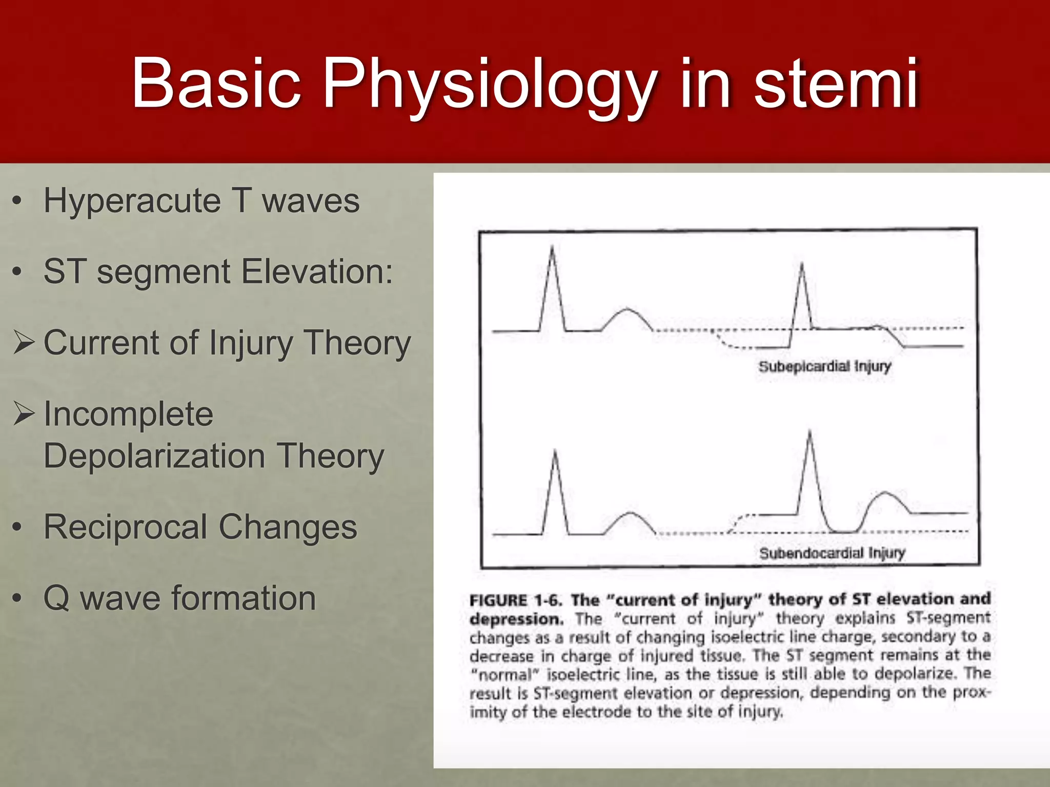 Atypical stemi patterns and stemi equivalents | PPTX | Heart and ...