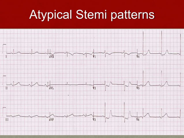 Atypical stemi patterns and stemi equivalents | PPTX | Heart and ...