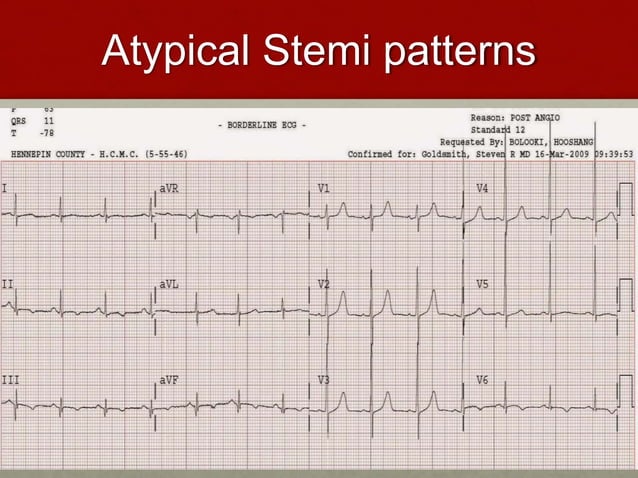 Atypical stemi patterns and stemi equivalents | PPTX | Heart and ...