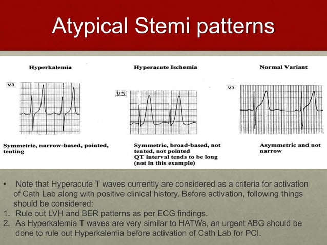 Atypical stemi patterns and stemi equivalents | PPTX | Heart and ...
