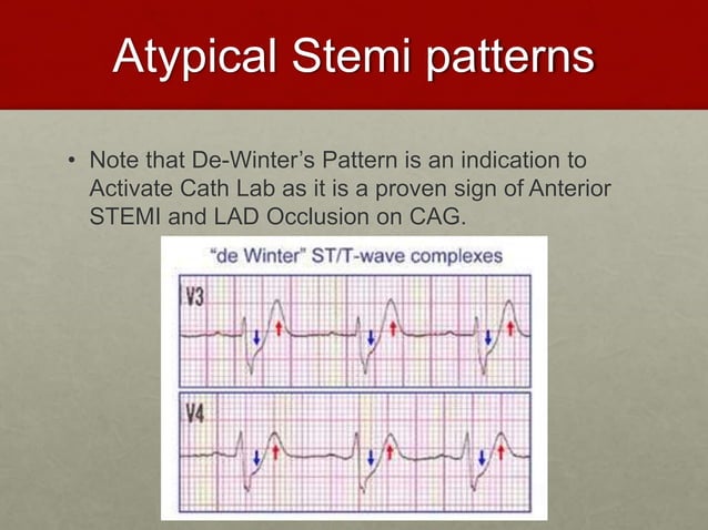 Atypical stemi patterns and stemi equivalents | PPTX | Heart and ...