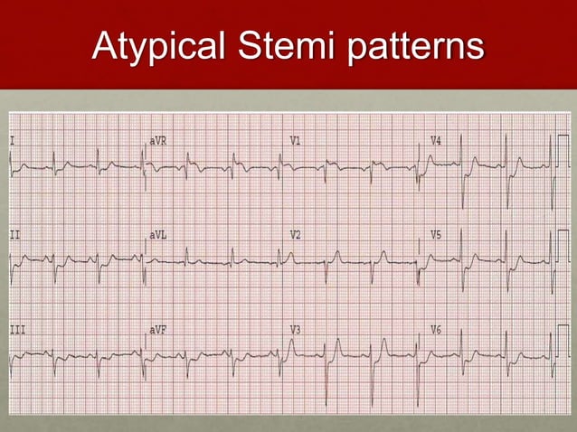Atypical stemi patterns and stemi equivalents | PPTX | Heart and ...
