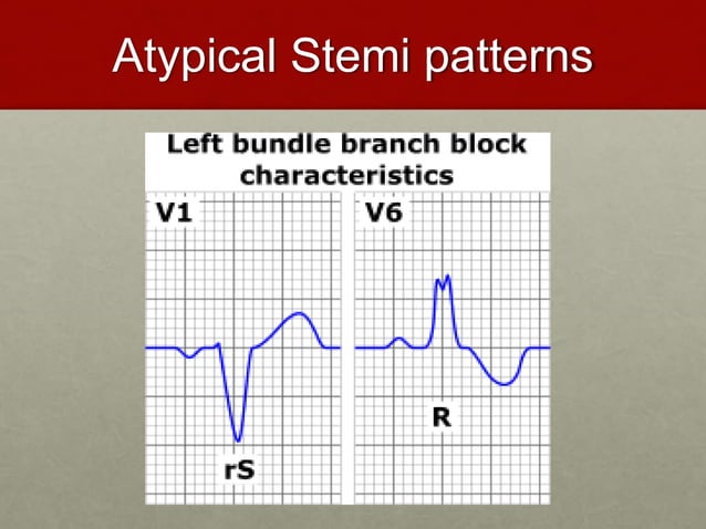 Atypical stemi patterns and stemi equivalents | PPTX | Heart and ...