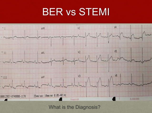 Atypical stemi patterns and stemi equivalents | PPTX | Heart and ...
