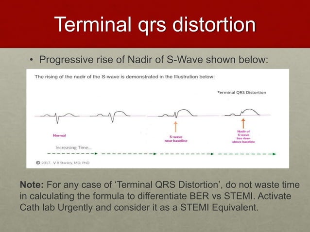 Atypical stemi patterns and stemi equivalents | PPTX | Heart and ...
