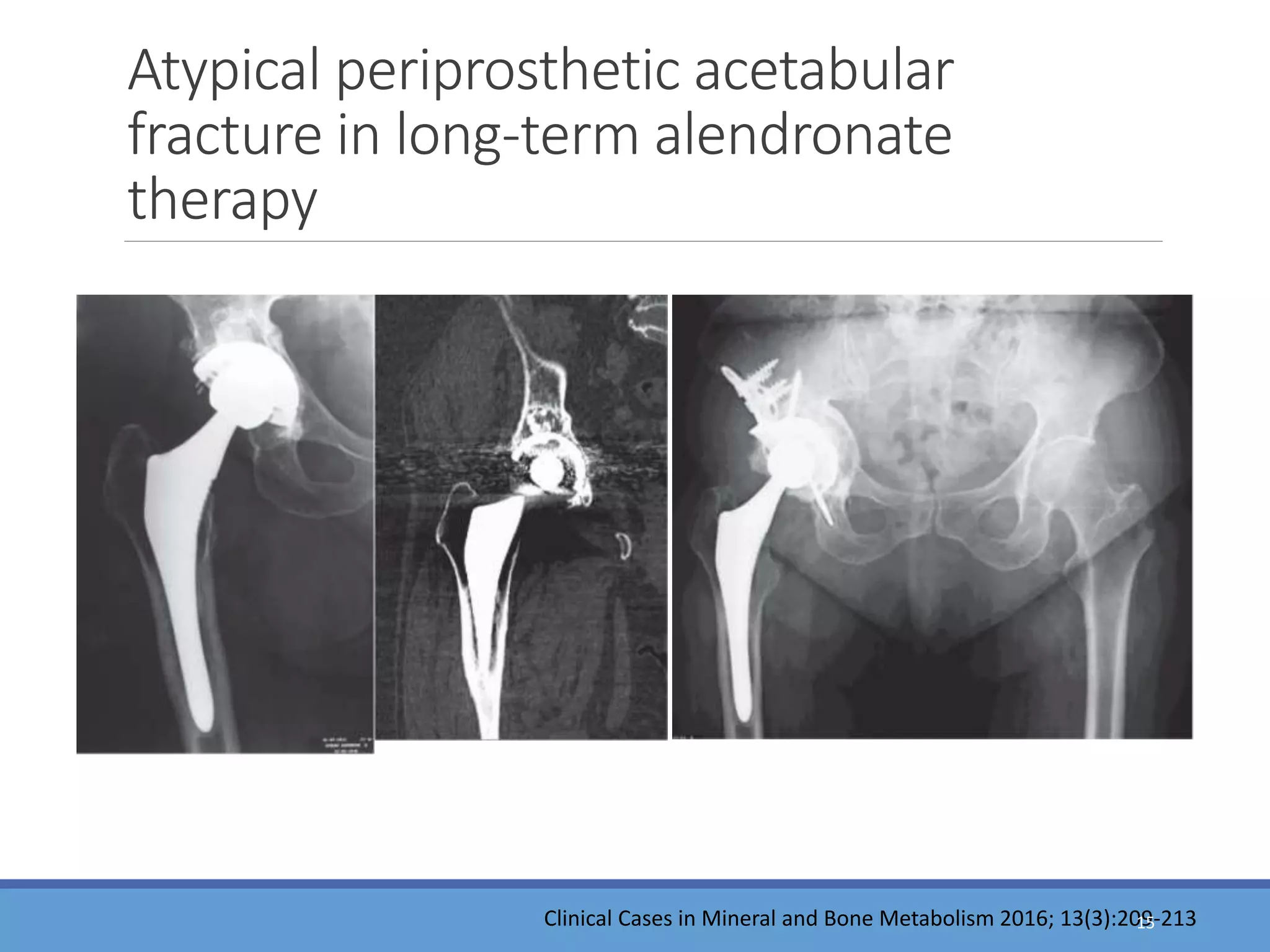 Management of atypical THA periprosthetic fracture | PDF