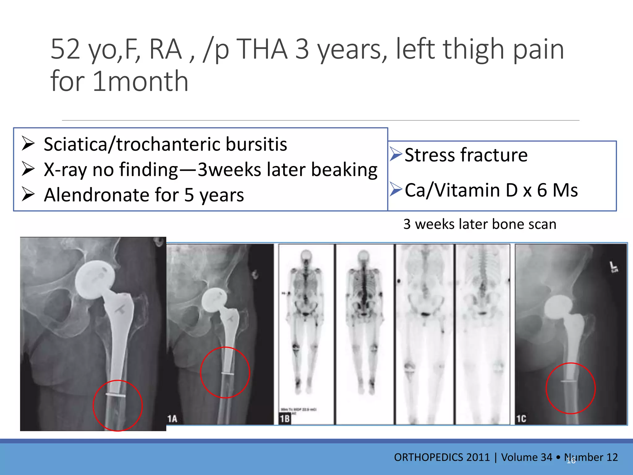 Management of atypical THA periprosthetic fracture | PDF