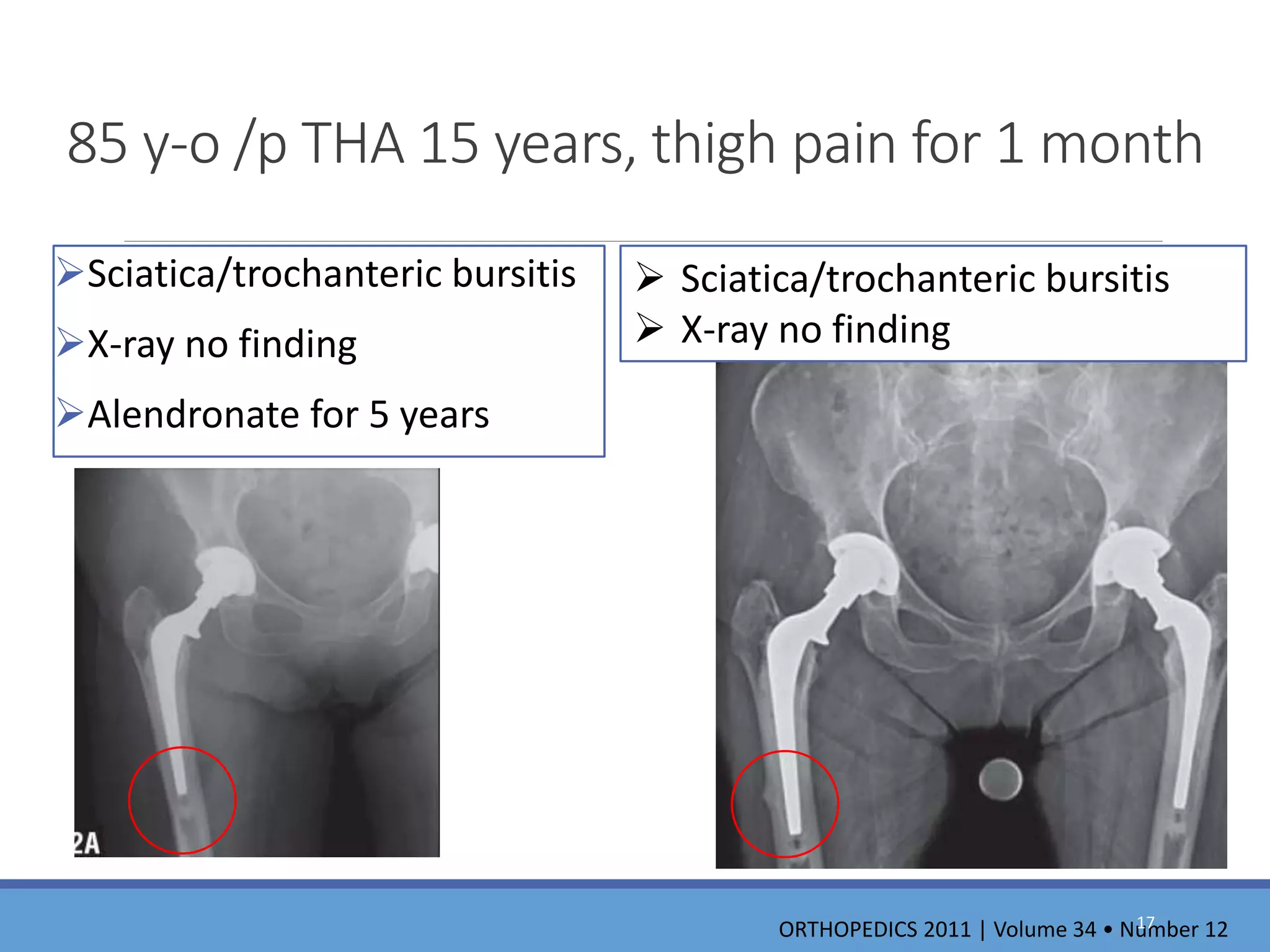 Management of atypical THA periprosthetic fracture | PDF