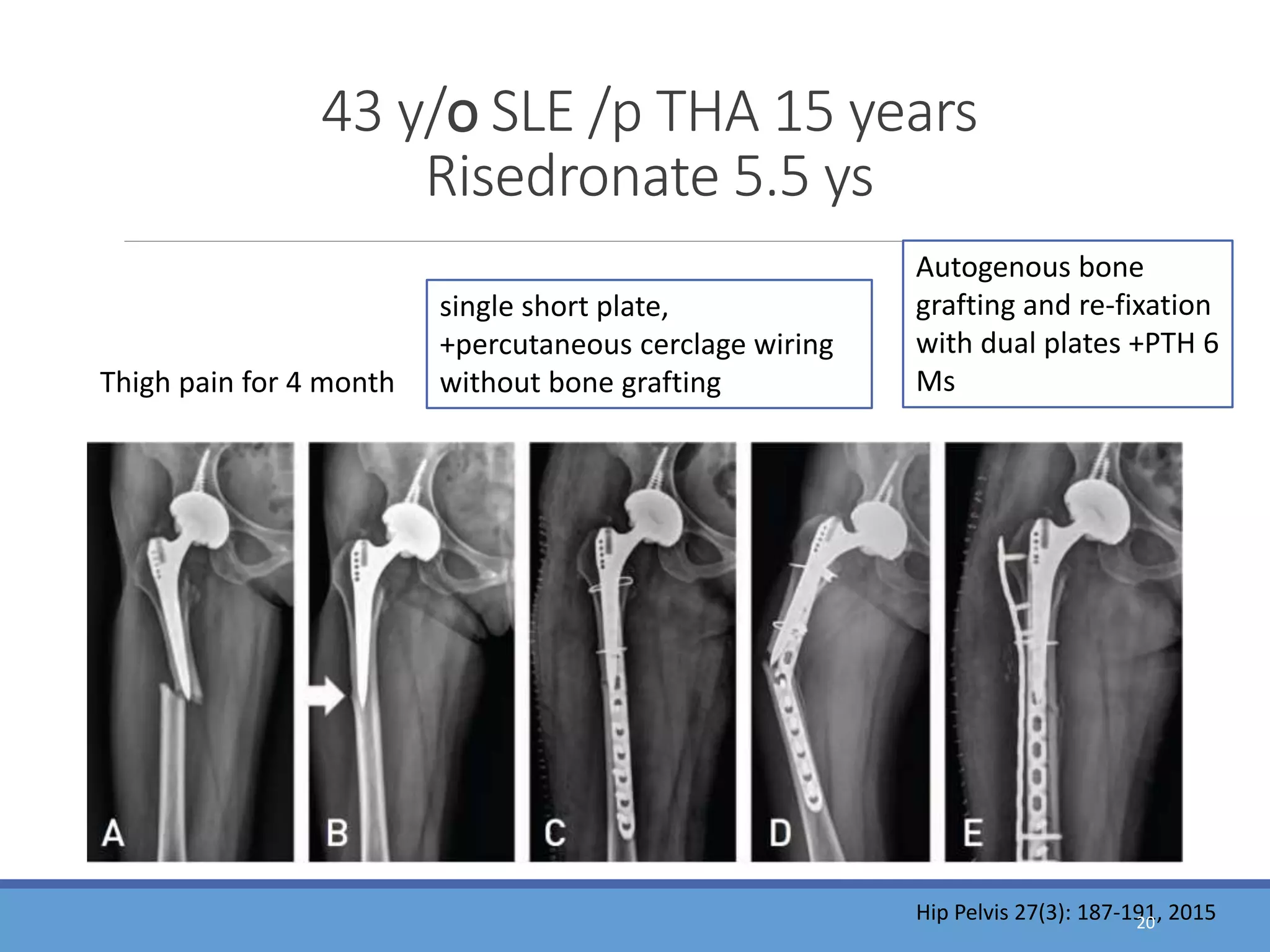 Management of atypical THA periprosthetic fracture | PDF