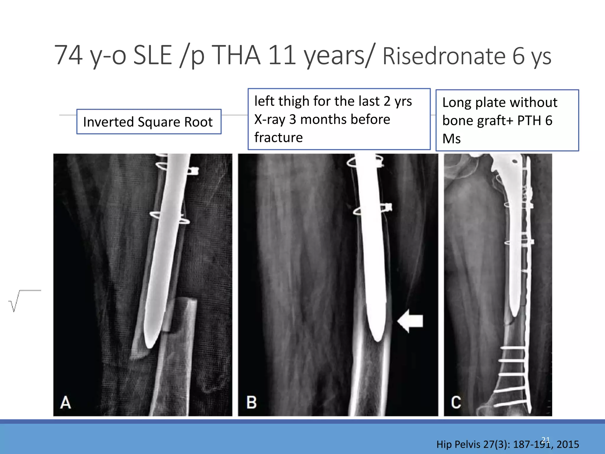Management of atypical THA periprosthetic fracture | PDF
