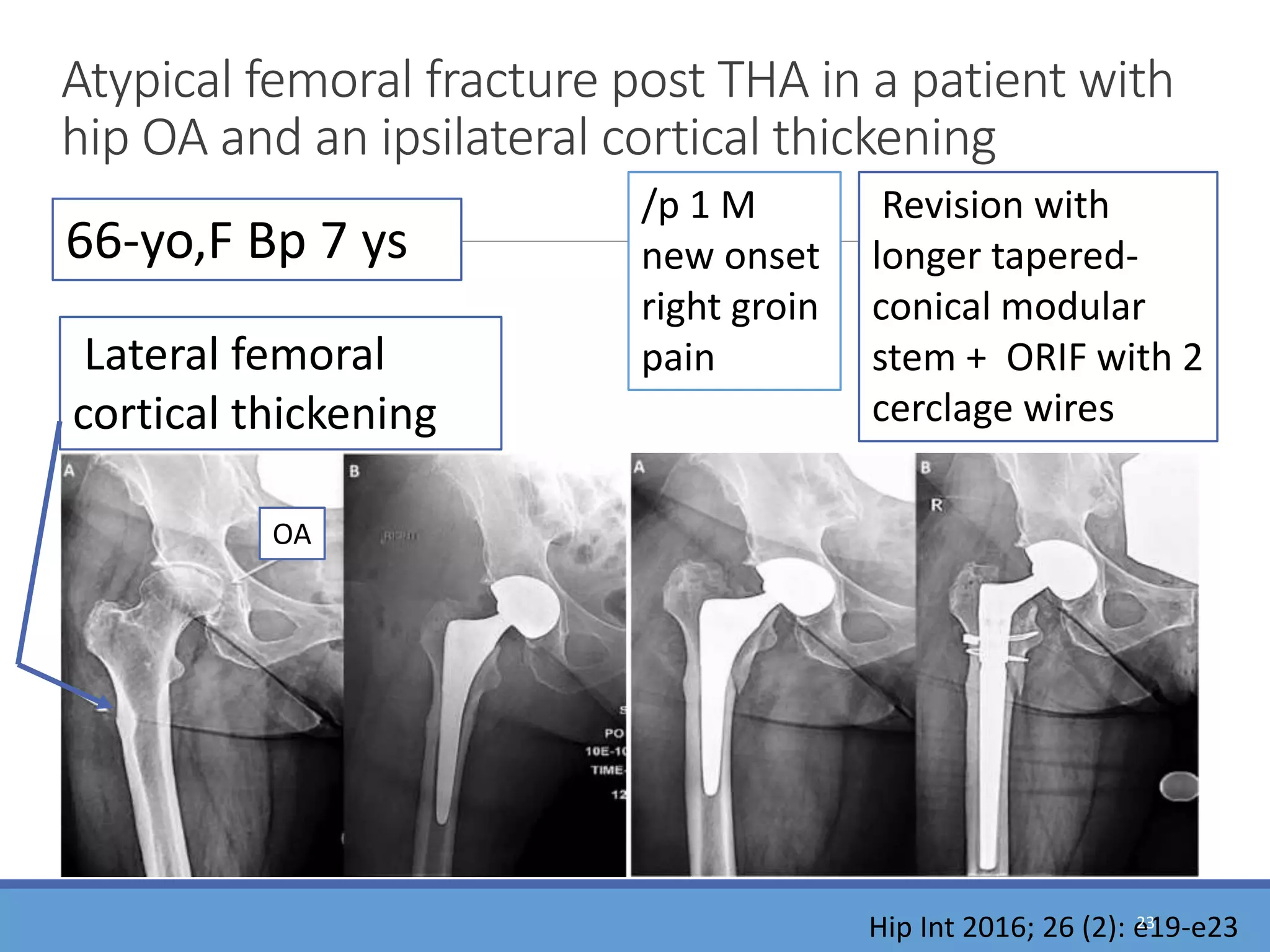 Management of atypical THA periprosthetic fracture | PDF