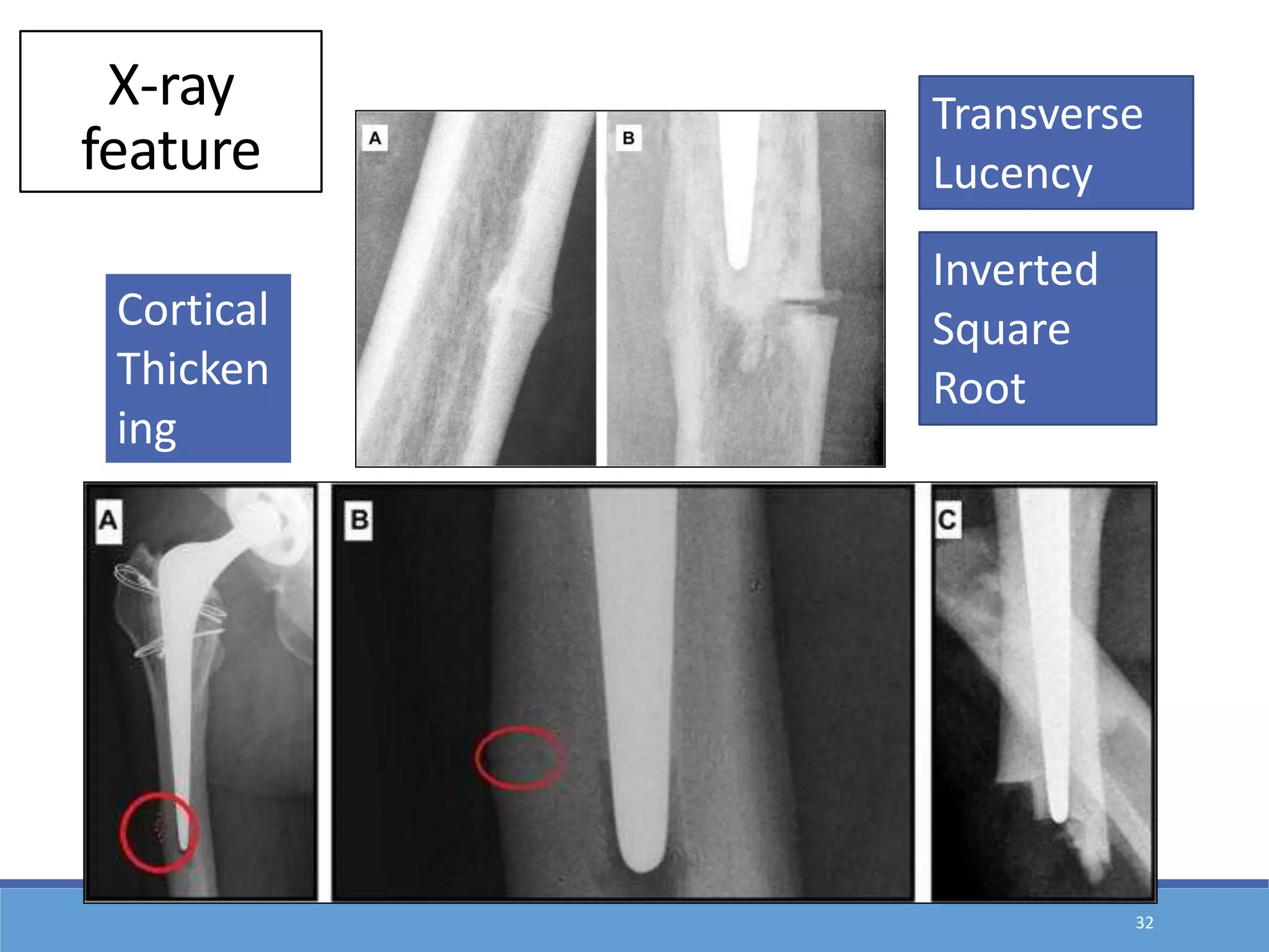 Management of atypical THA periprosthetic fracture | PDF