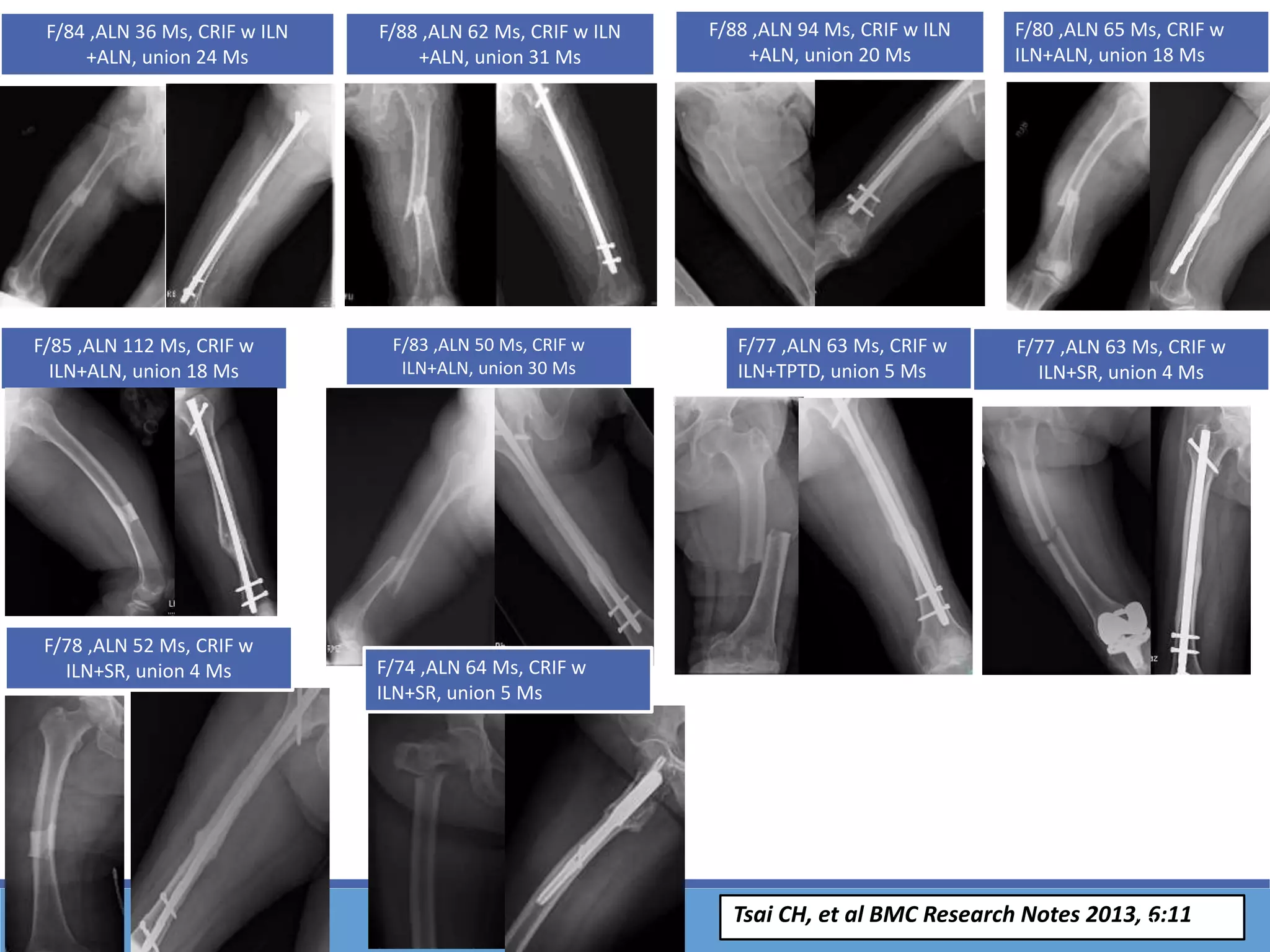 Management of atypical THA periprosthetic fracture | PDF