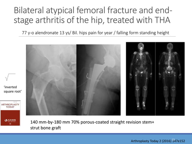Management of atypical THA periprosthetic fracture | PDF | Physical ...