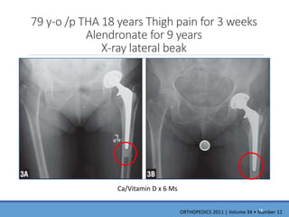 Management of atypical THA periprosthetic fracture | PDF