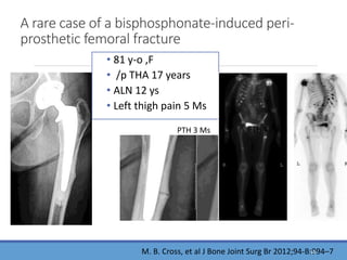 Management of atypical THA periprosthetic fracture | PDF