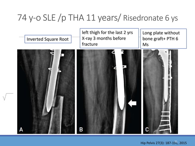 Management of atypical THA periprosthetic fracture | PDF | Physical ...