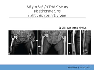 Management of atypical THA periprosthetic fracture | PDF