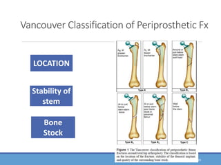 Management of atypical THA periprosthetic fracture | PDF