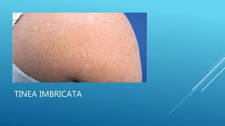 Atypical tinea | PPTX