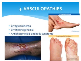 Atypical wounds | PPTX