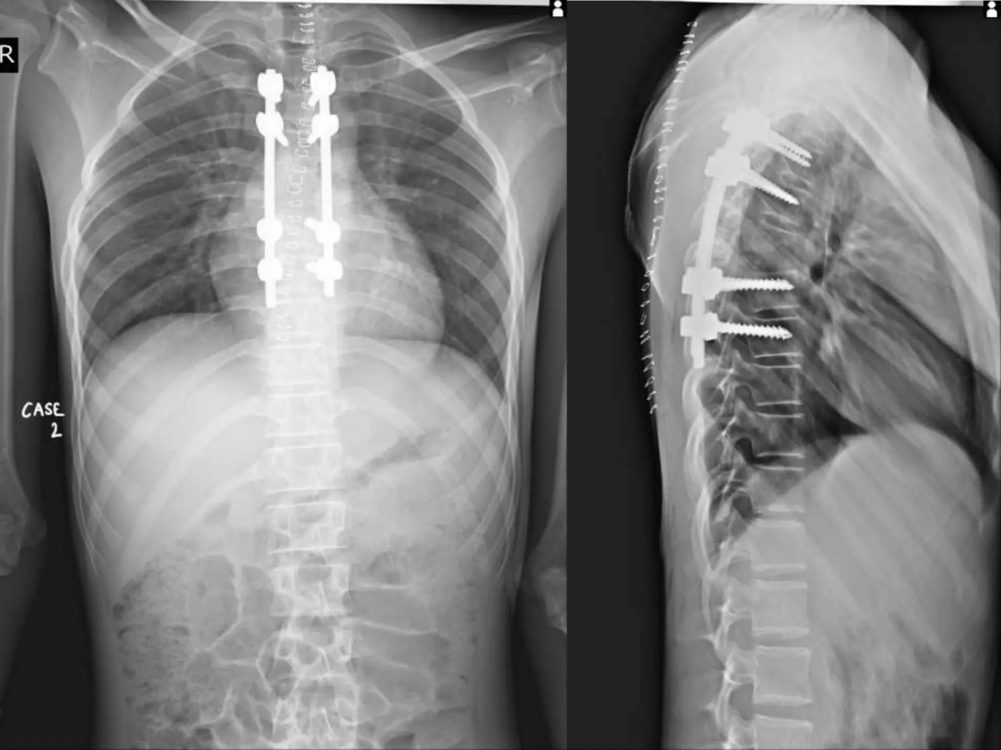 Infective spondylodiscitis case 2 | PPT
