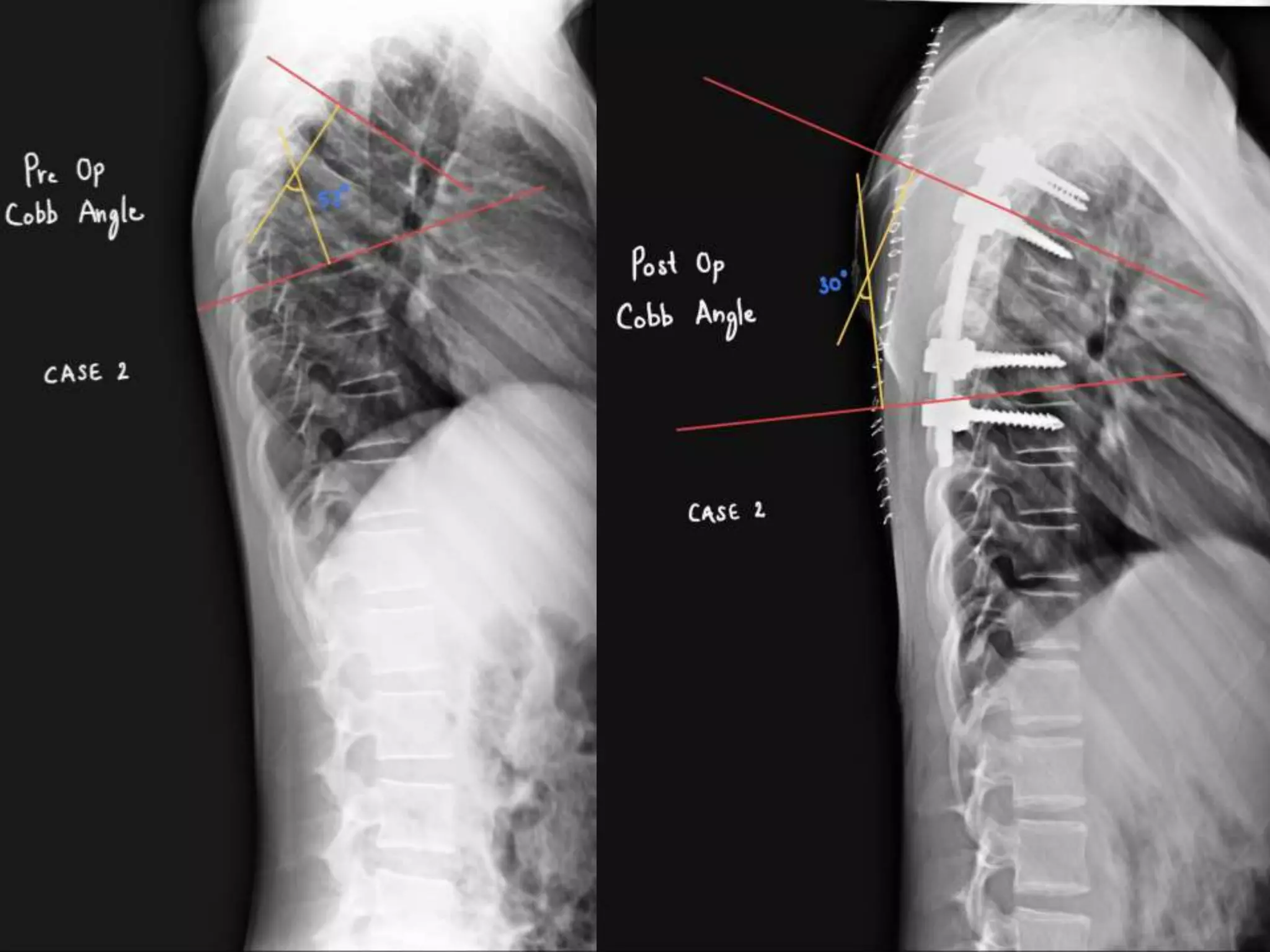 Infective spondylodiscitis case 2 | PPT