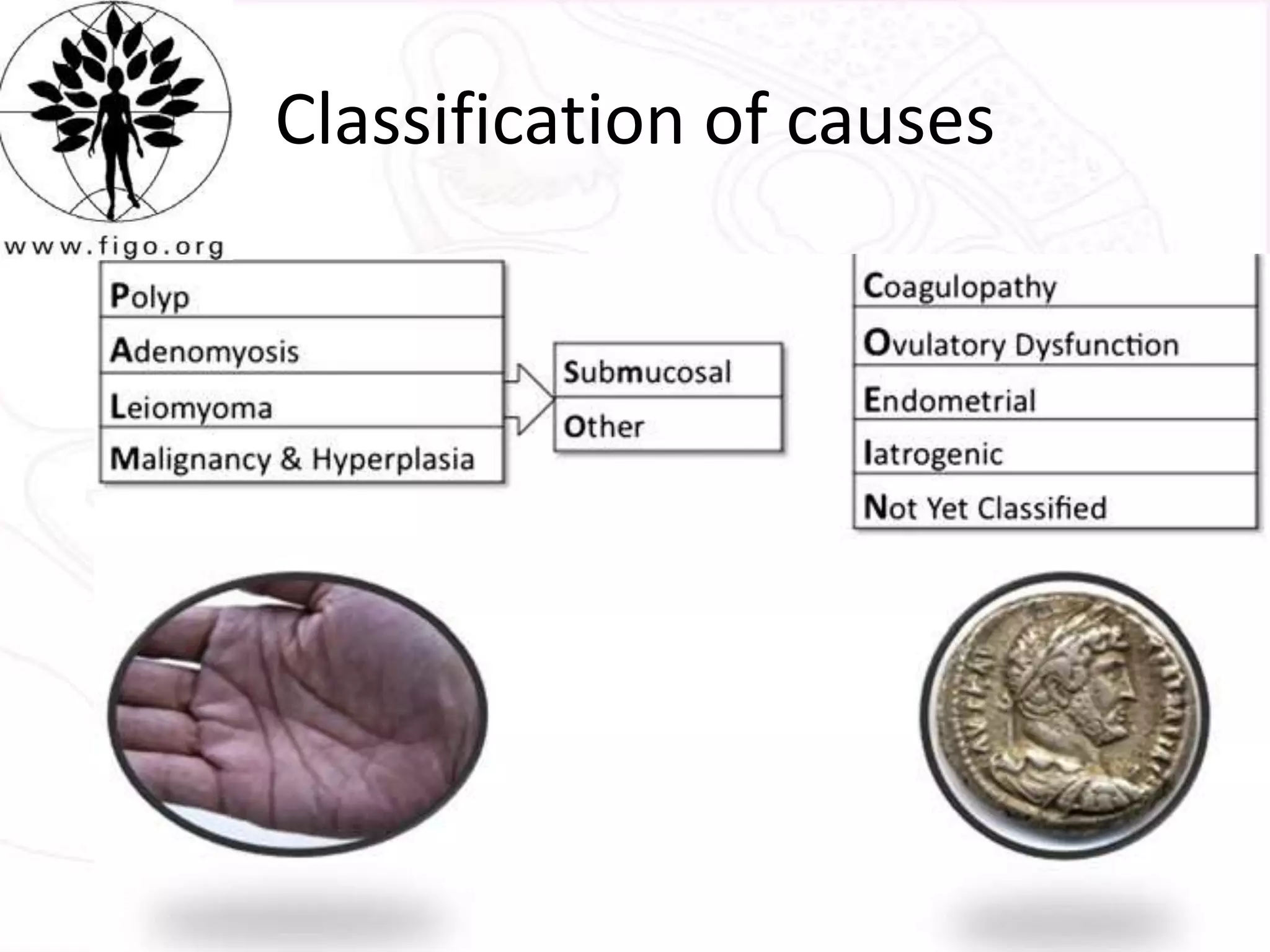 AUB : Definition, Epidemology and Causes | PPTX | Pregnancy ...