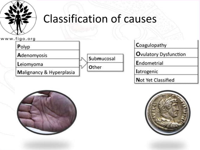 AUB : Definition, Epidemology and Causes | PPT