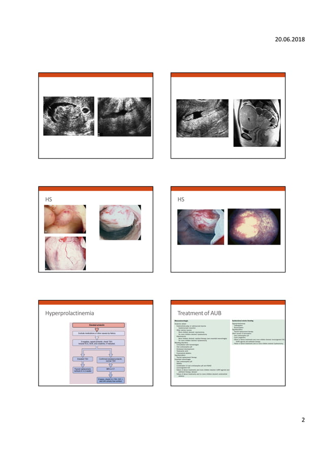 Abnormal uterine bleeding | PDF