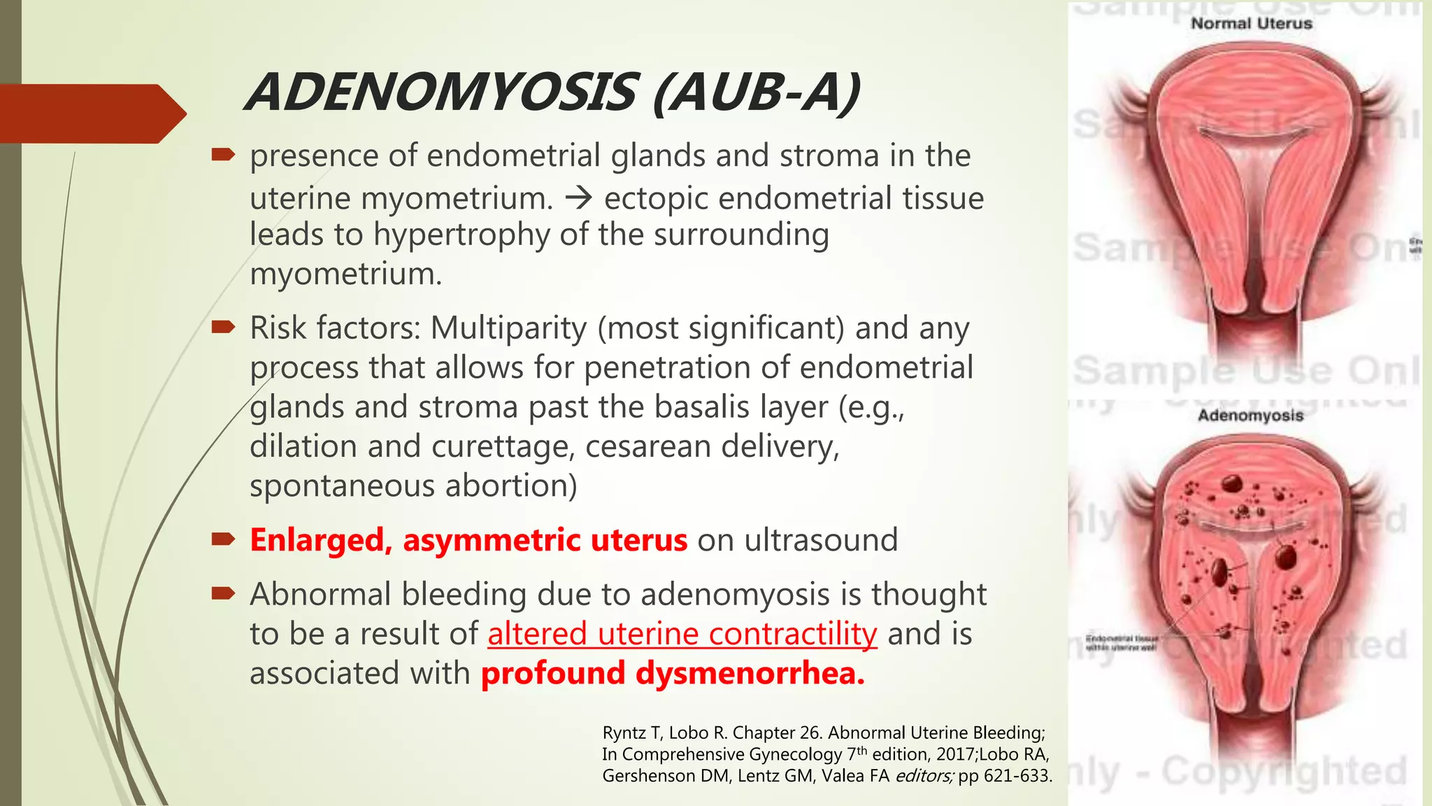 Abnormal Uterine Bleeding | PPTX