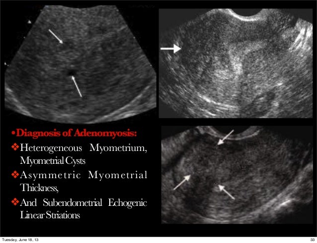 Abnormal Uterine Bleeding -Update