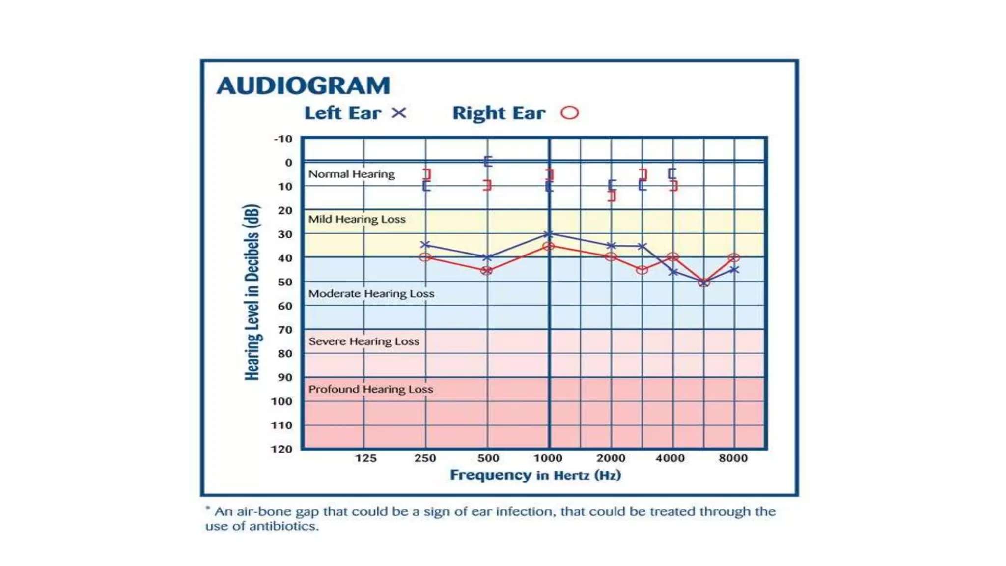 Audiogram and Tympanogram-Dr.Bagasi.pptx