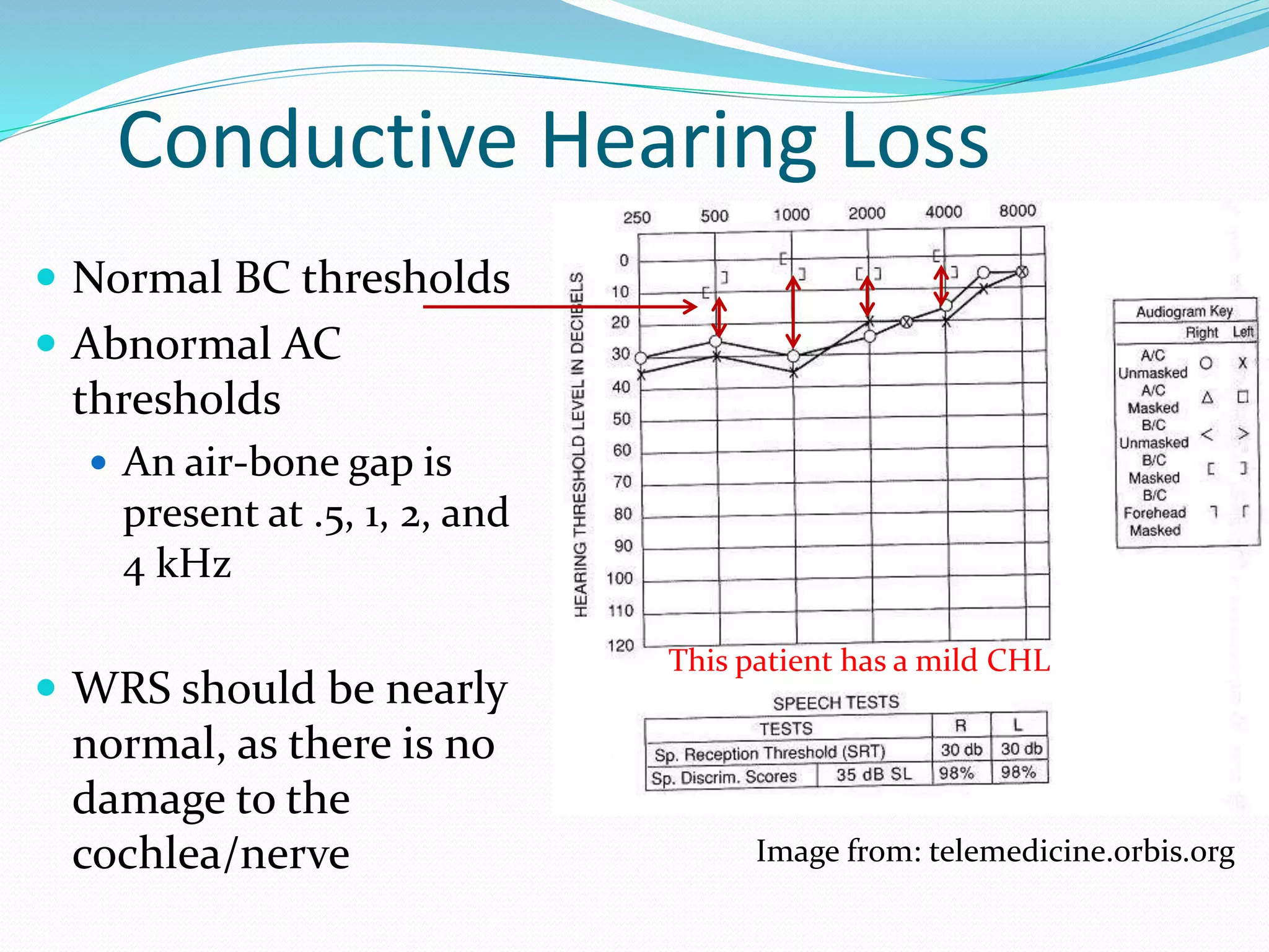 Audiogram interpretation | PPTX