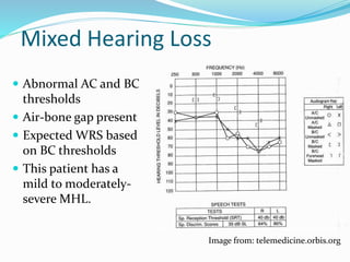 Audiogram interpretation | PPTX